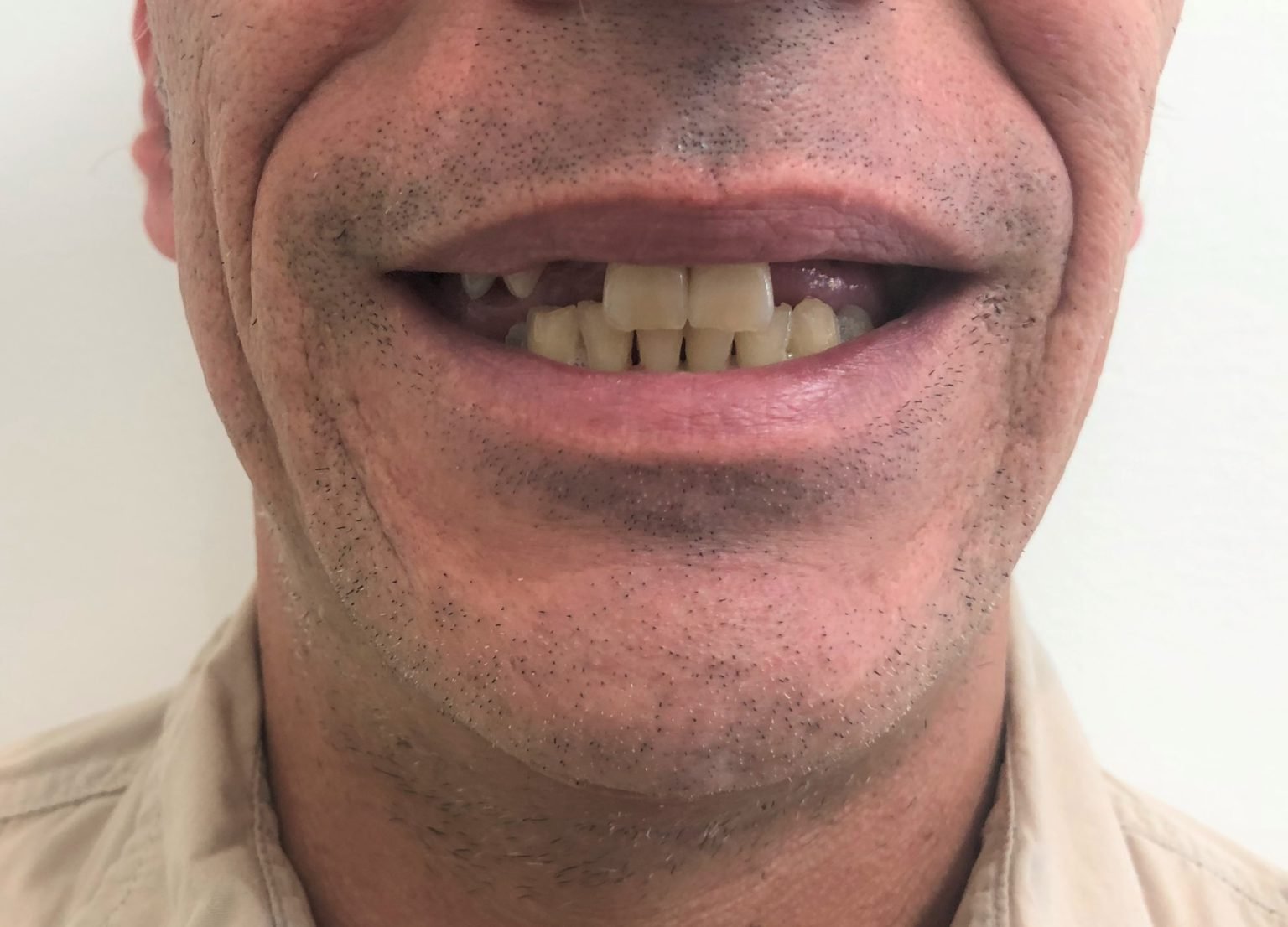 How to Fix A Missing Teeth | Dental Implant